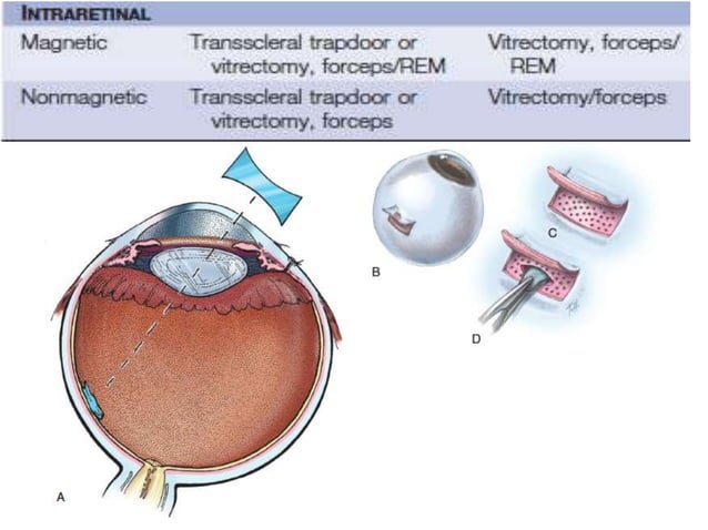 Siderosis &chalcosis & IOFB | PPTX | Eye and Vision Conditions ...