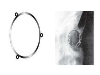 Siderosis &chalcosis & IOFB | PPTX