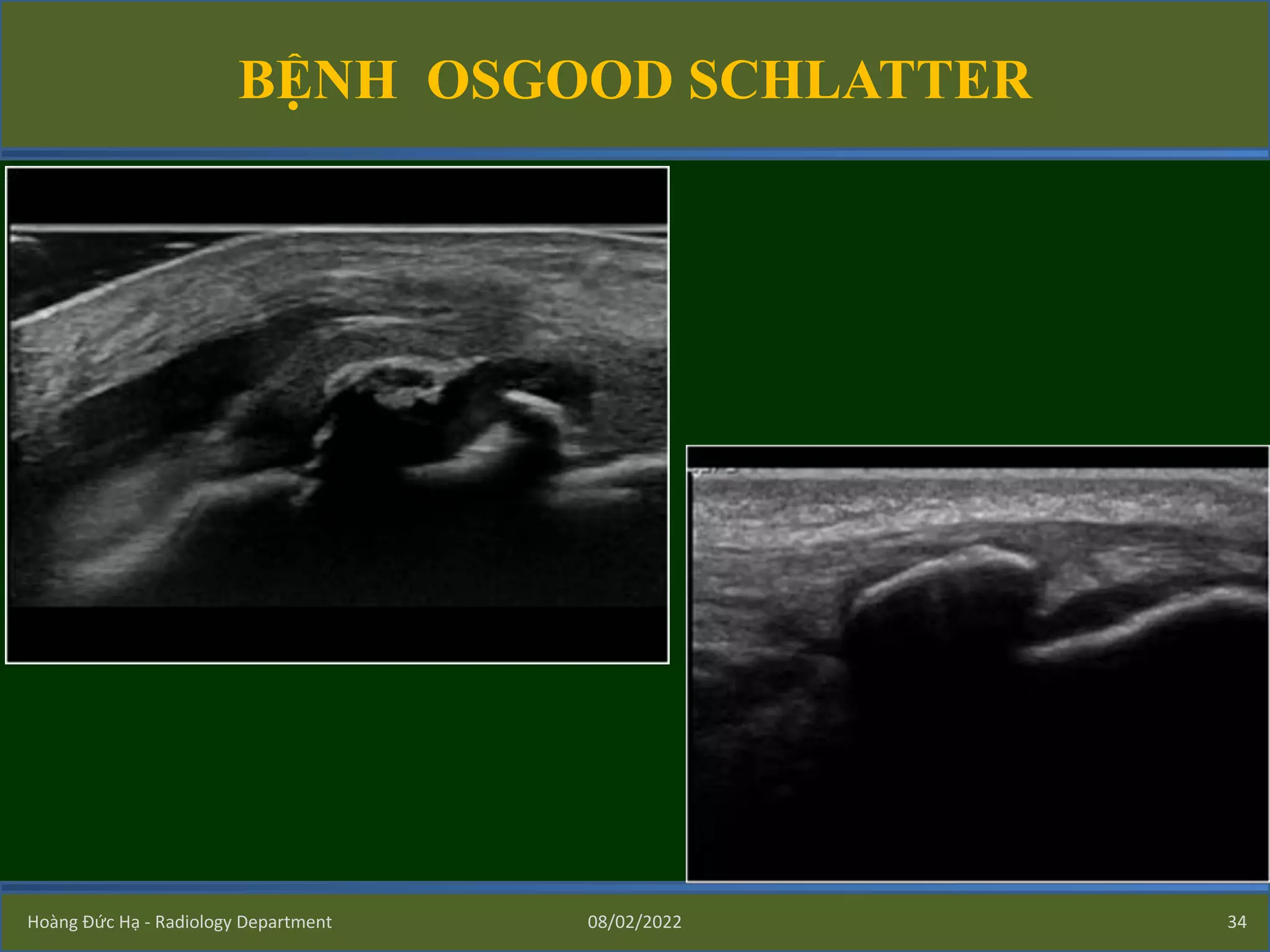 Sieu am Khop Goi _ Hoang Duc Ha.pdf