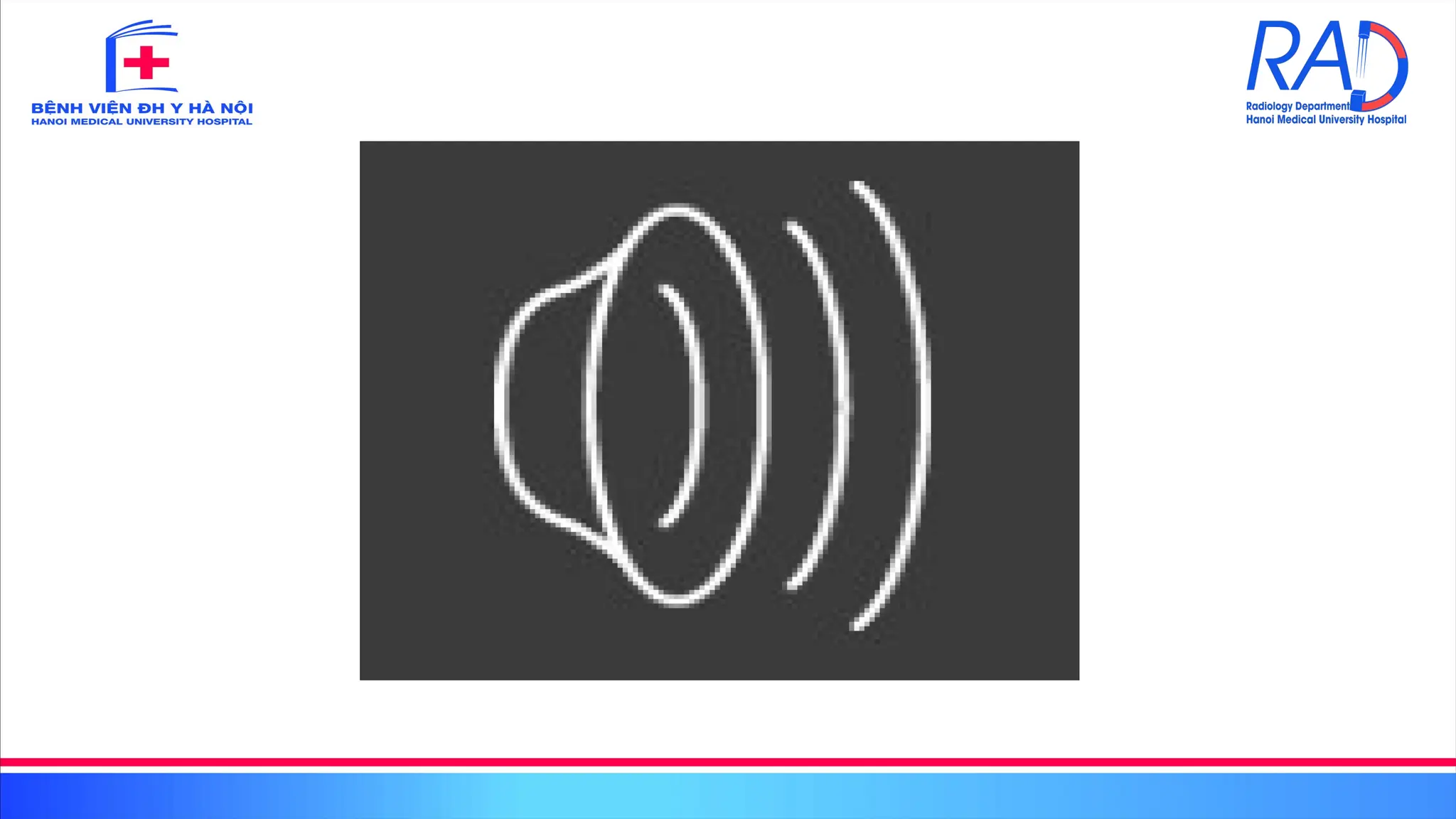 Sieu am tinh mach chan- bvdh y ha noi.pptx