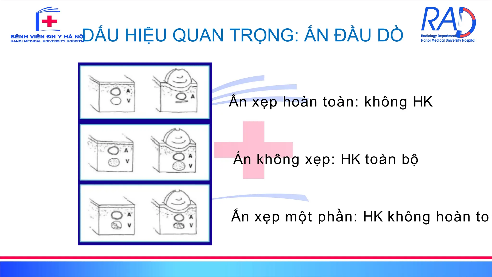 Sieu am tinh mach chan- bvdh y ha noi.pptx