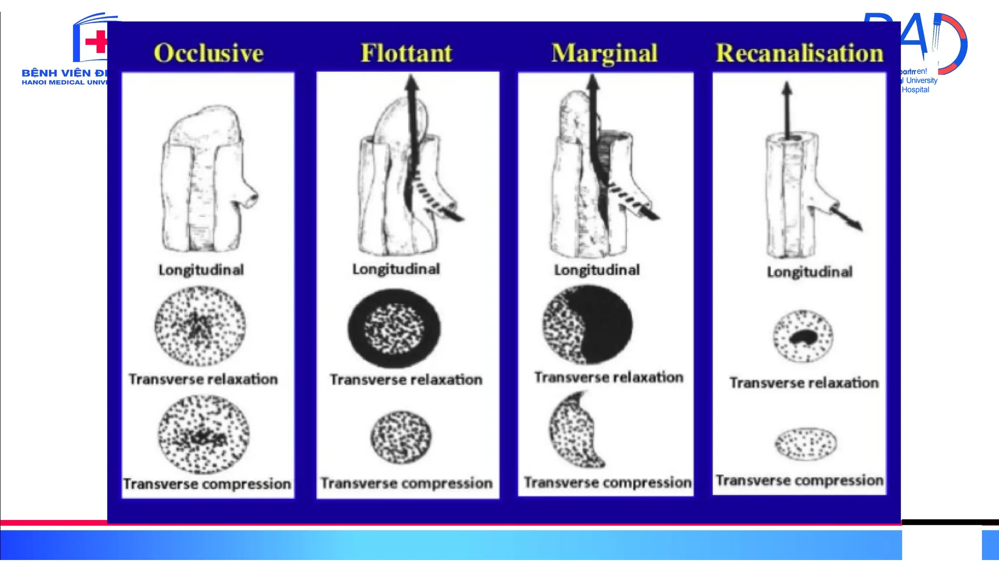 Sieu am tinh mach chan- bvdh y ha noi.pptx