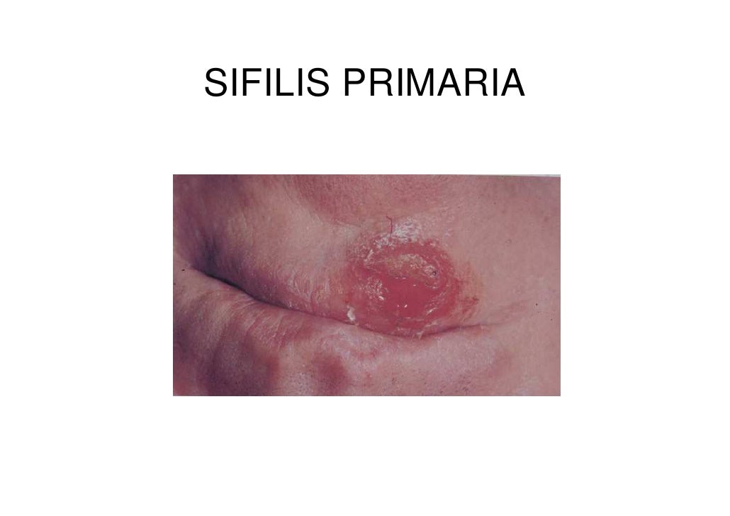 Sifilis
