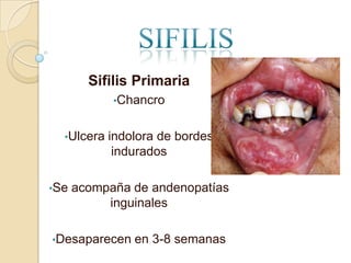 Sifilis