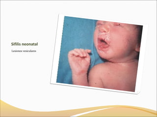 Sifilis | PPT