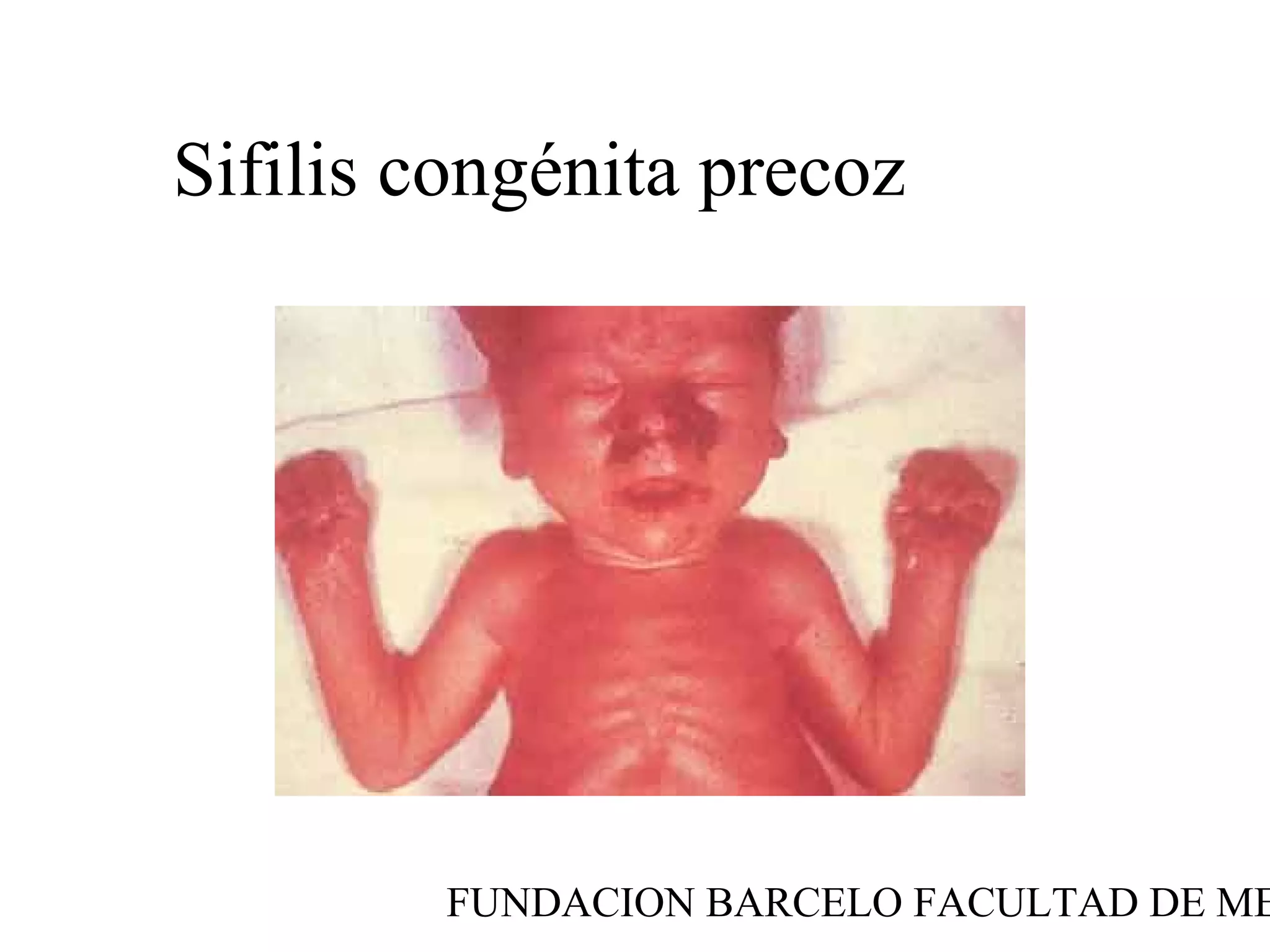 Sifilis | PPT