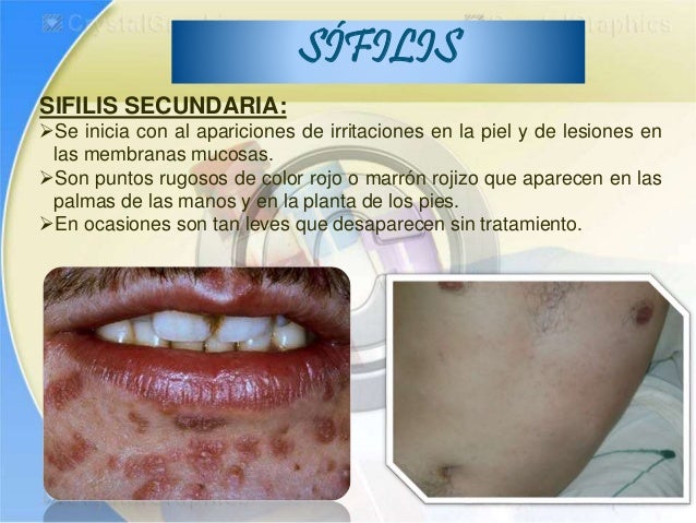 Sifilis