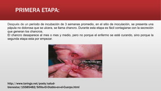 Sifilis | PPTX