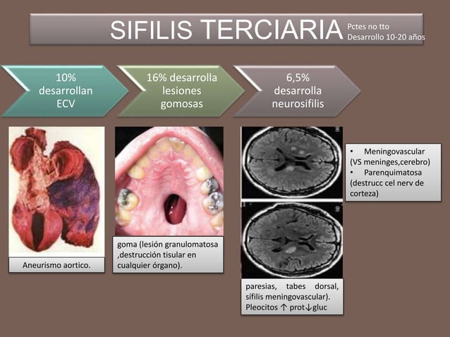 Aorta Sifilis Terciaria