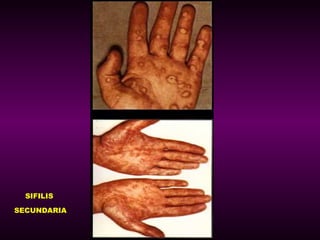 Sifilis 2006 | PPT
