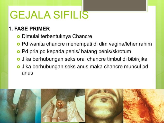 sifilis.pptx