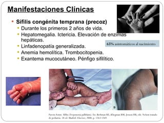 sifilis-congenita-maria-eugenia-guillot.ppt
