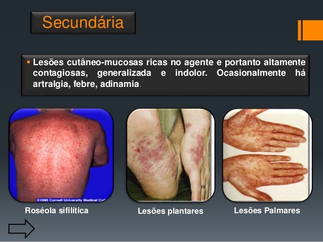 Assistência de Enfermagem Sífilis