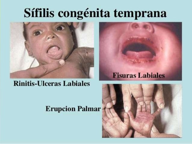 Sifilis congenita