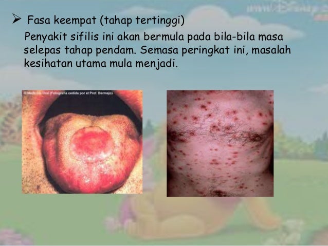 penyakit serius sifilis