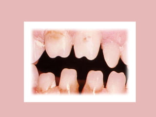 Sifilis para treinameto no jubim | PPT