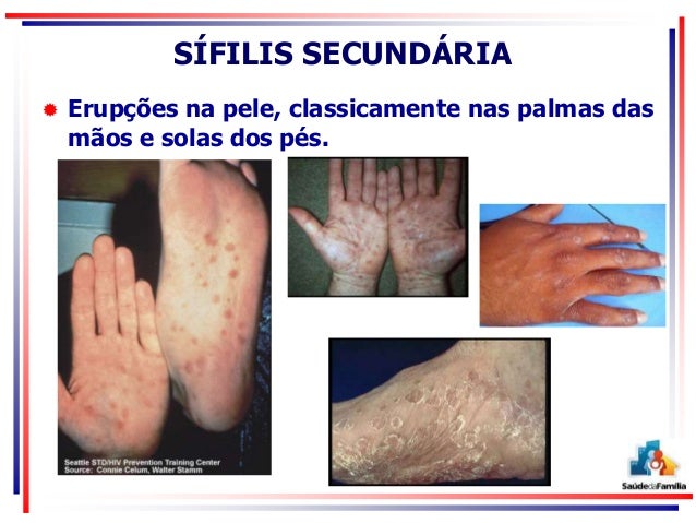 SIFILIS NO PSF