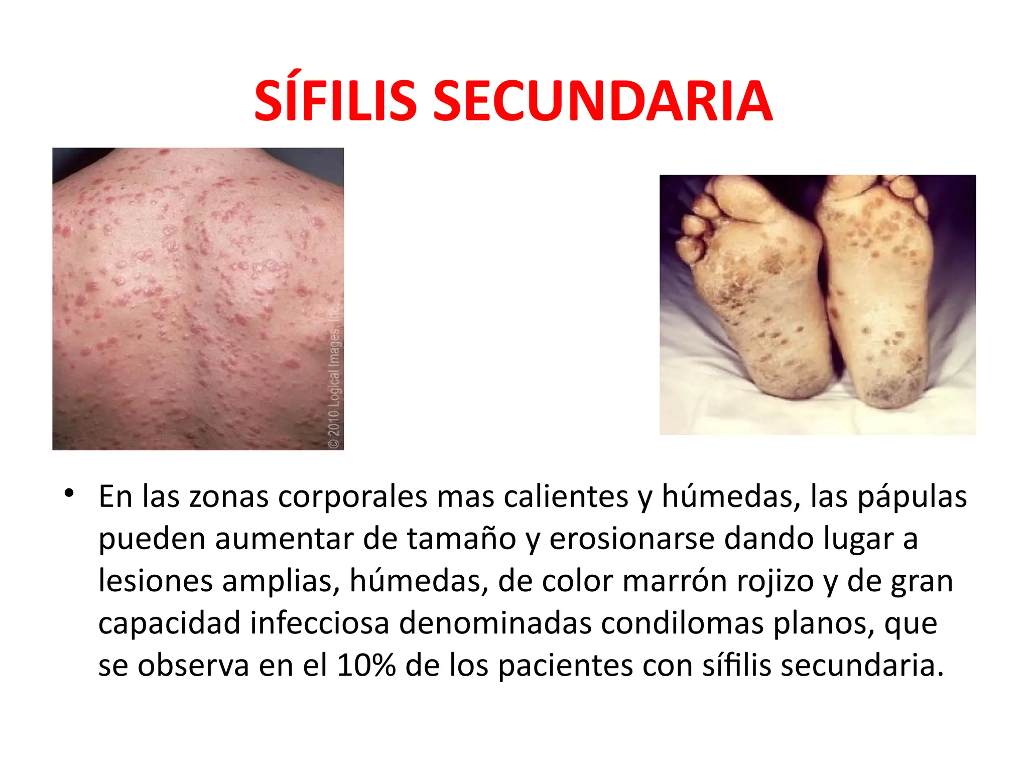 Sifilis y Herpes. en patologia clinicapptx | PPTX
