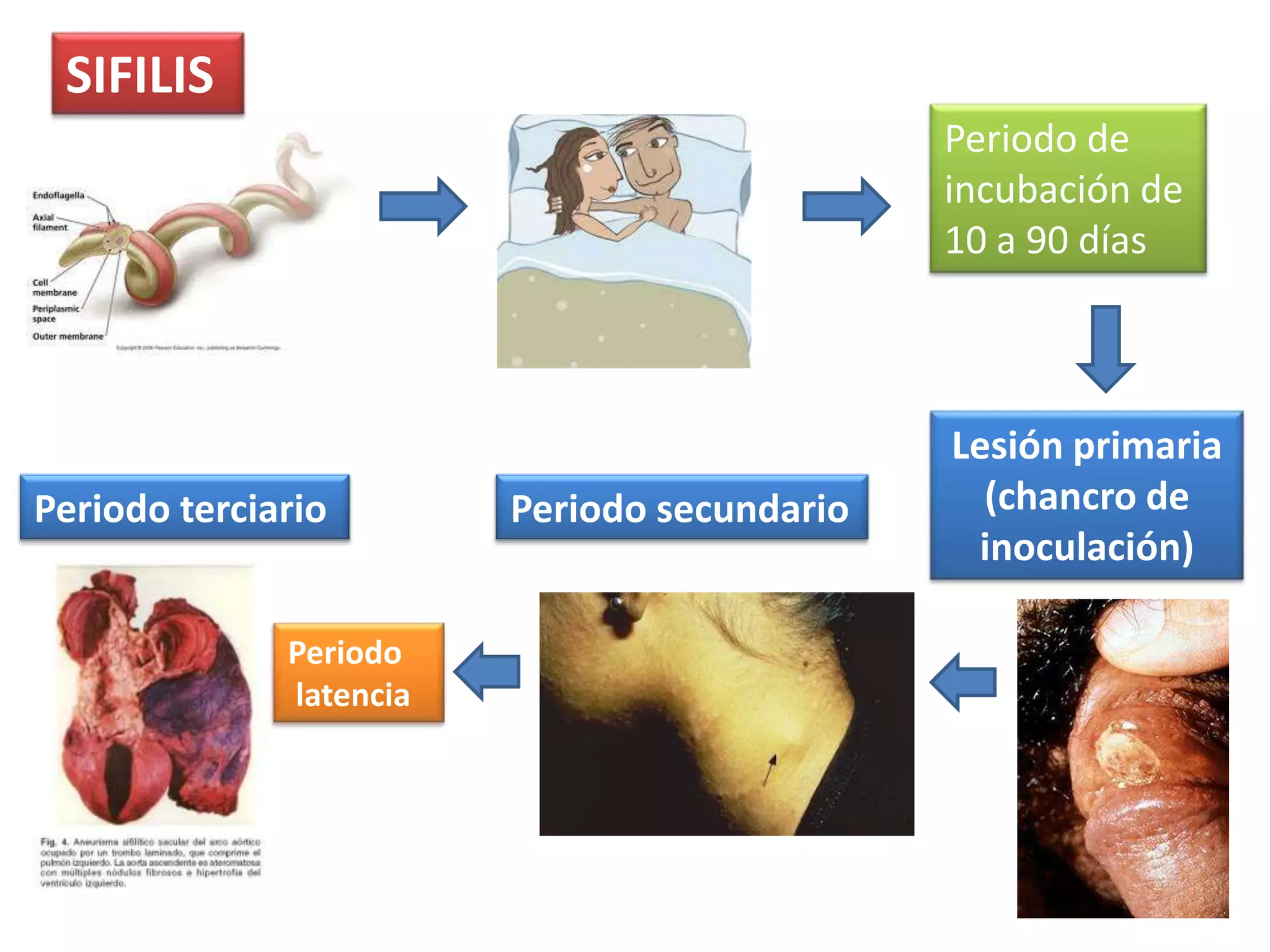 Sifilis y ulceras genitales de transmision sexual final | PPTX
