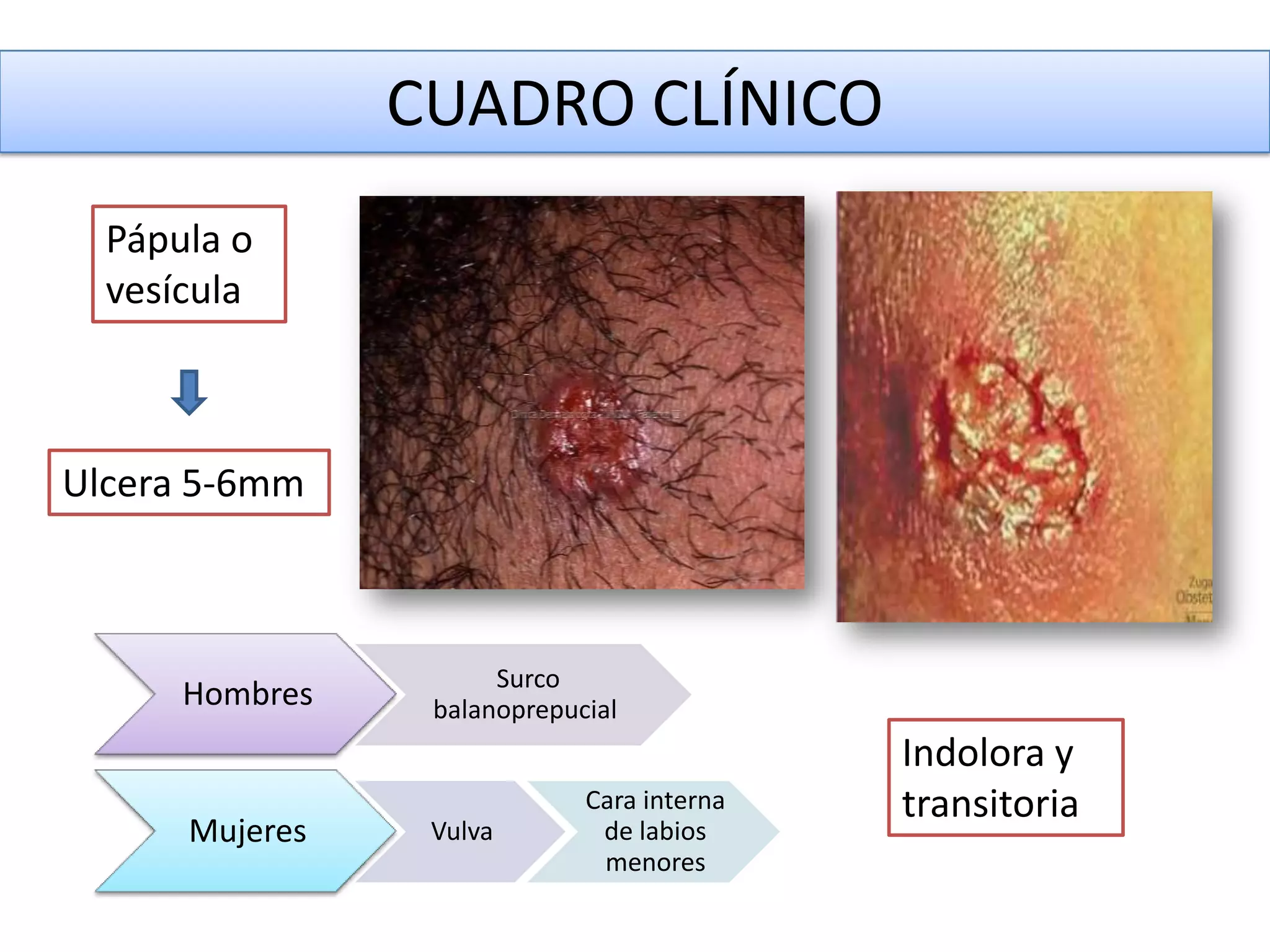 Sifilis y ulceras genitales de transmision sexual final | PPTX