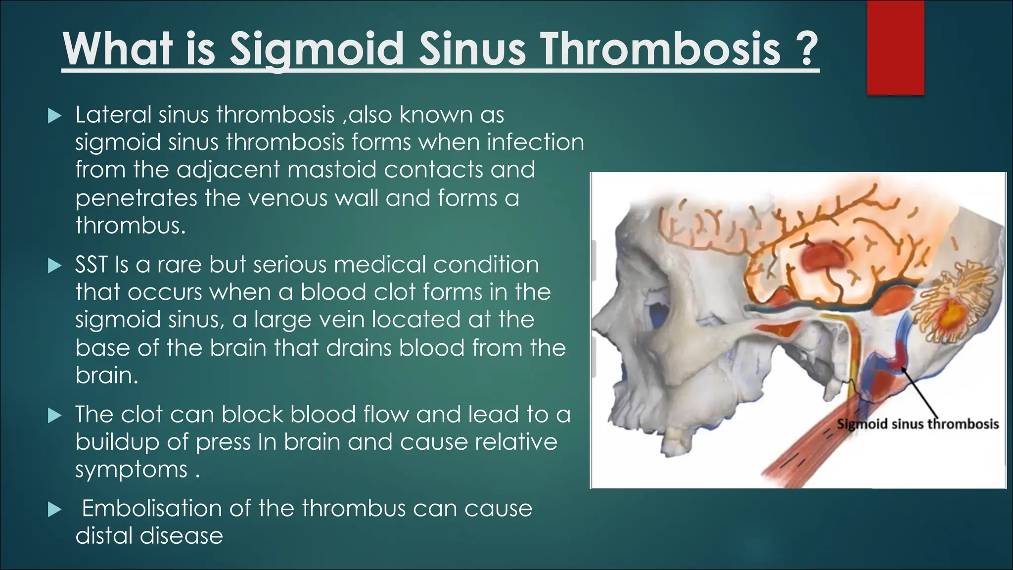 Sigmoid Sinus Thrombosis In Otolaryngology Ppt