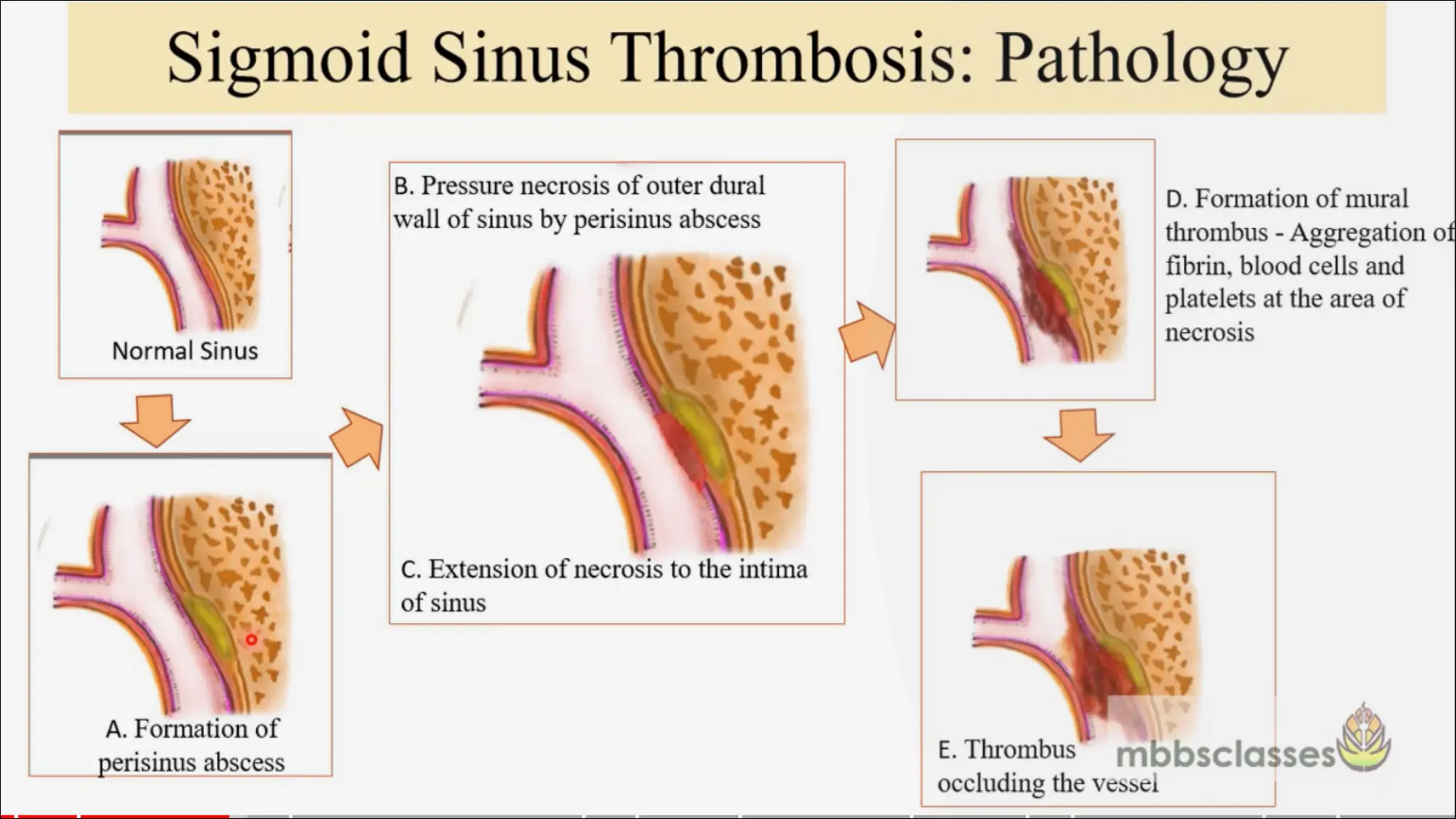Sigmoid sinus thrombosis in otolaryngology | PDF