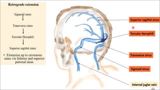Sigmoid sinus thrombosis in otolaryngology | PDF
