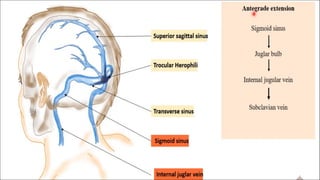 Sigmoid sinus thrombosis in otolaryngology | PDF