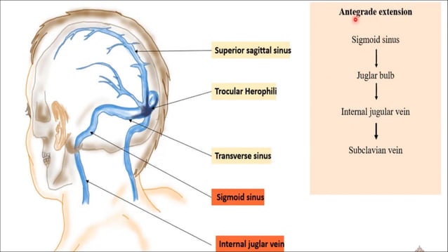 Sigmoid sinus thrombosis in otolaryngology | PDF