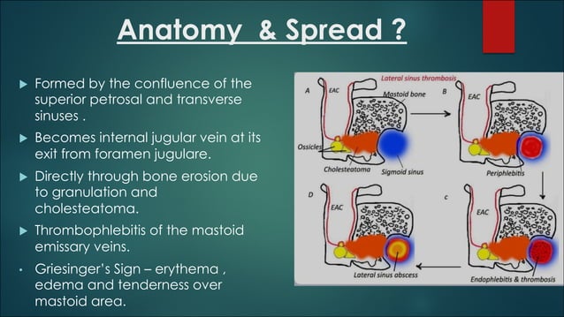 Sigmoid sinus thrombosis in otolaryngology | PDF