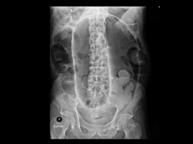 Sigmoid volvulus | PPTX