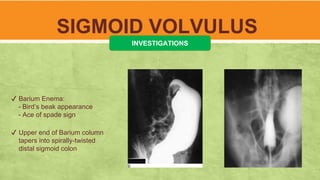sigmoidvolvulus-generalisedabdominalpain-200716114516.pptx