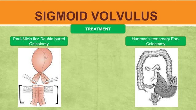 sigmoidvolvulus-generalisedabdominalpain-200716114516.pptx