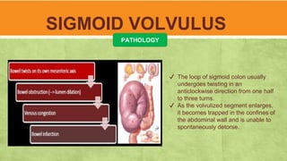 sigmoidvolvulus-generalisedabdominalpain-200716114516.pptx