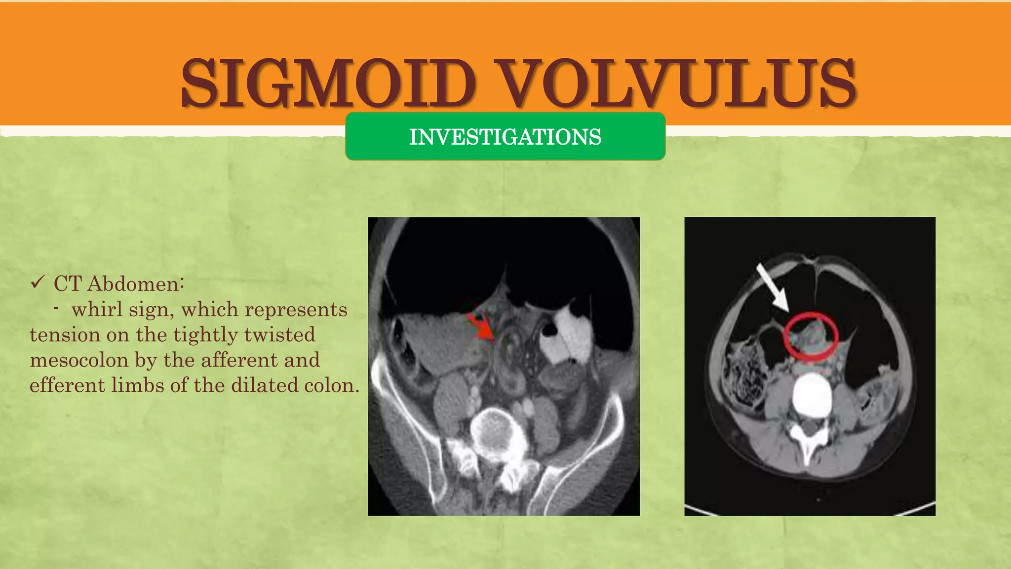 Sigmoid volvulus/ Generalised abdominal pain | PPTX