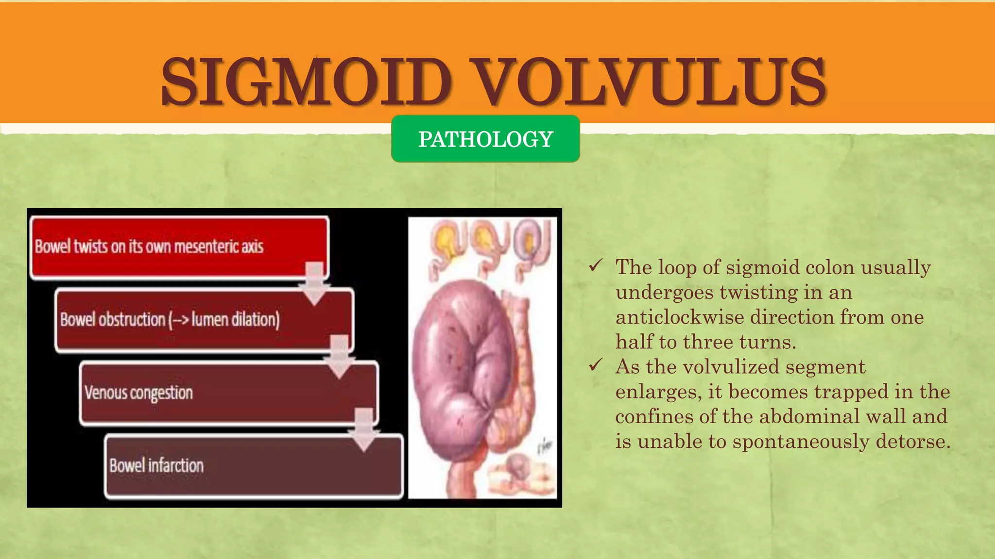 Sigmoid volvulus/ Generalised abdominal pain | PPTX