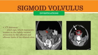 Sigmoid volvulus/ Generalised abdominal pain | PPTX