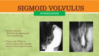 Sigmoid Volvulus Birds Beak