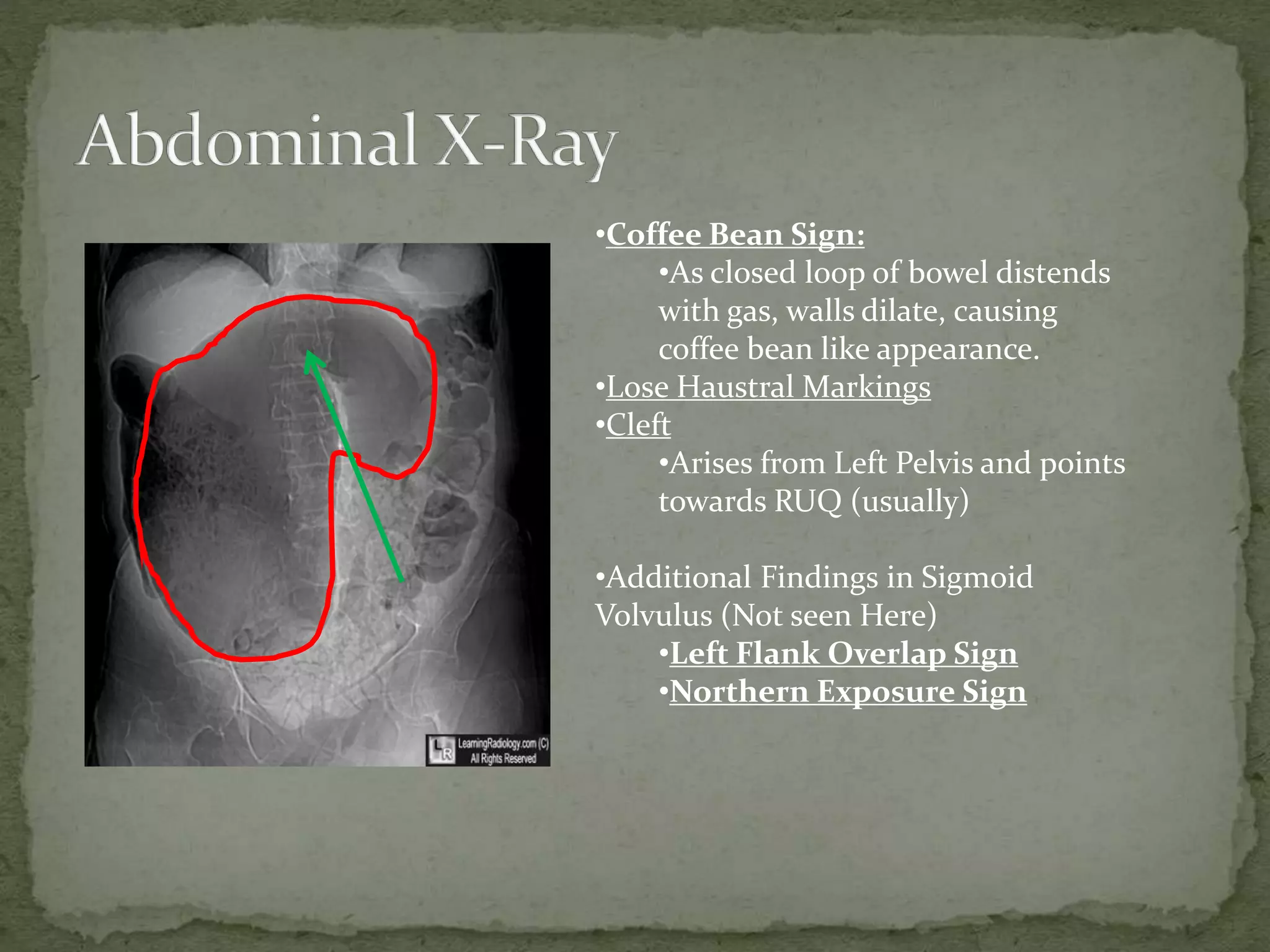 Sigmoid volvulus Power Point | PPTX
