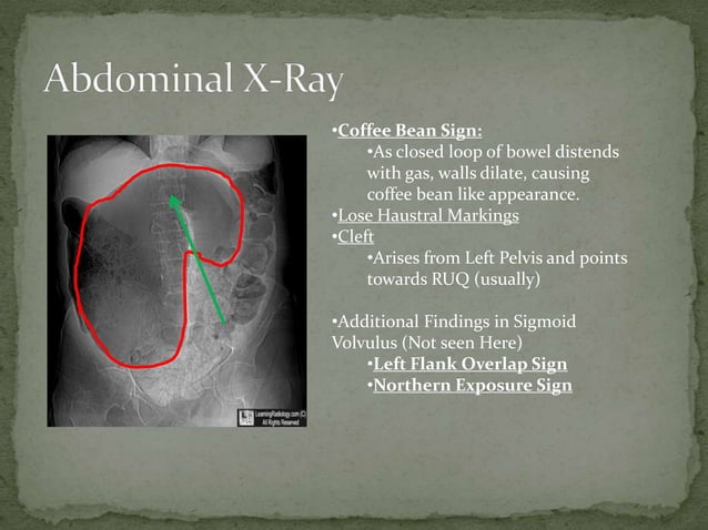 Sigmoid volvulus Power Point | PPTX | Digestive Disorders | Diseases ...