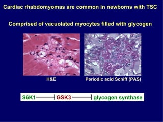 Signaling events triggered by inactivation of the TSC1-2 Complex ...