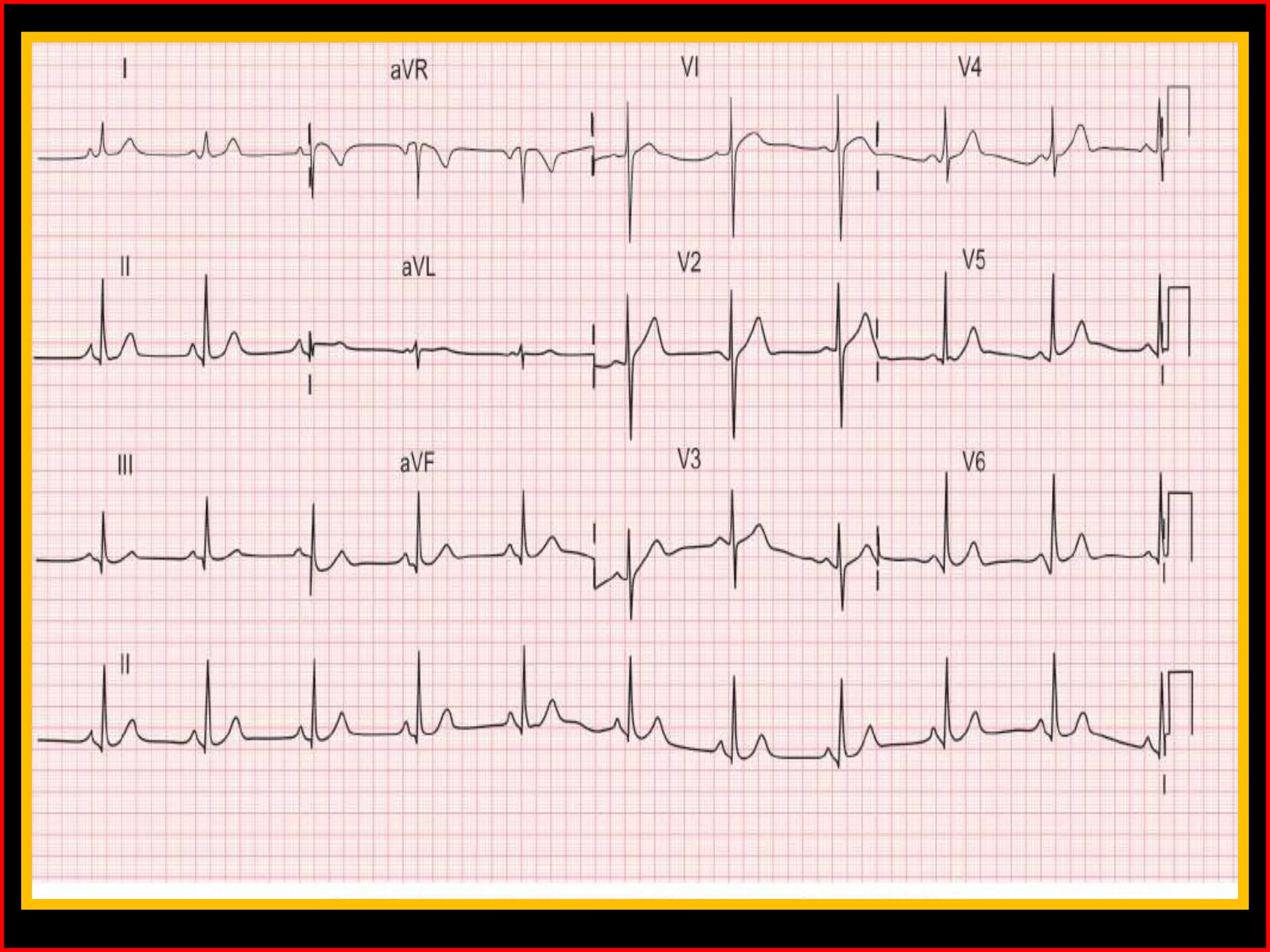 Significance of avR lead | PPTX