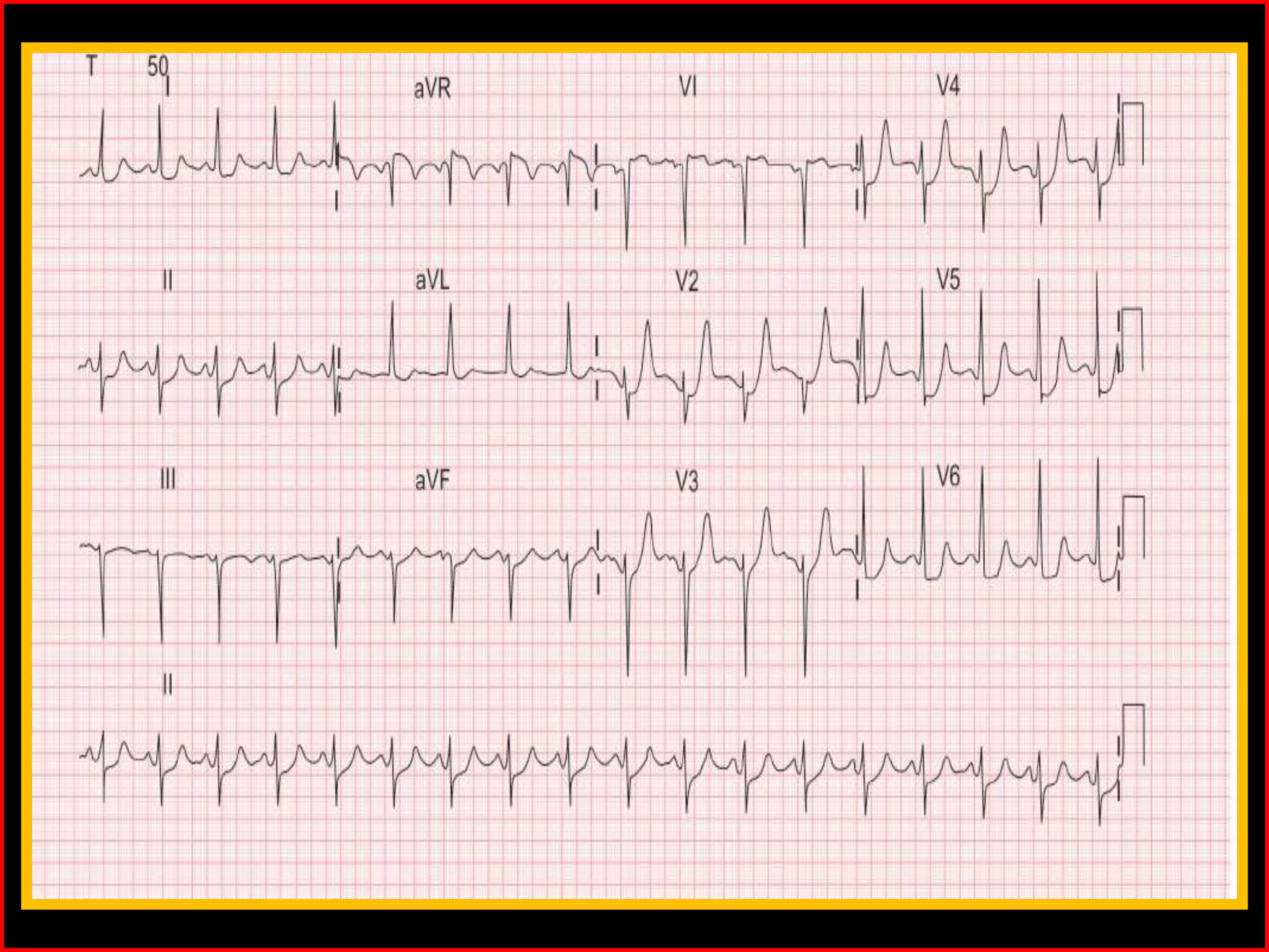 Significance of avR lead | PPTX