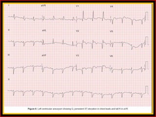 Significance of avR lead | PPTX