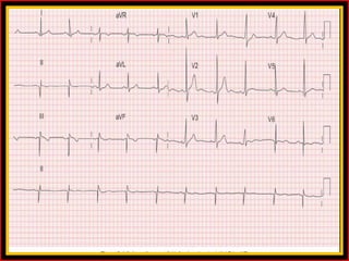 Significance of avR lead | PPTX