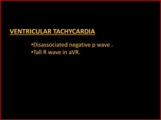 Significance of avR lead | PPT