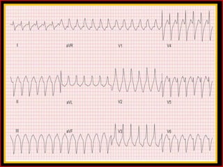 Significance of avR lead | PPTX