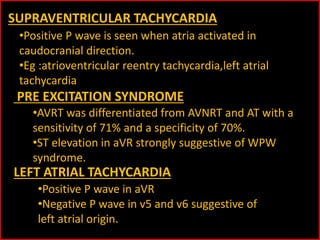 Significance of avR lead | PPT