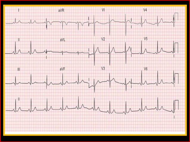 Significance of avR lead | PPT