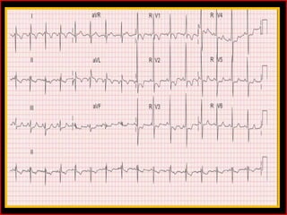 Significance of avR lead | PPTX